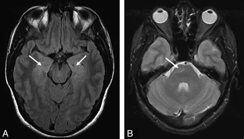Encephalitis Mri