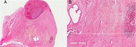 Mucosal Lentiginous Melanoma Semantic Scholar