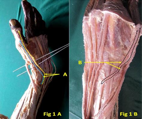 Extensor Pollicis Longus Cadaver
