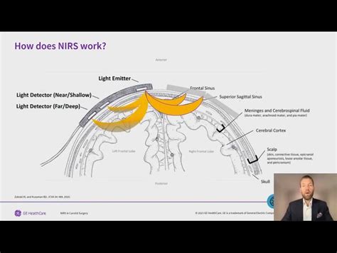 Monitoring Cerebral Oxygen Saturation For Your Carotid Endarterectomy Cea Patients Clinical View
