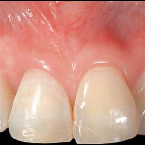 Pdf The Connective Tissue Platform Technique For Soft Tissue Augmentation