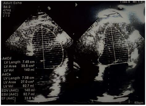 Apical 4 Chambers A4c Echocardiography Moderately Decreased Left