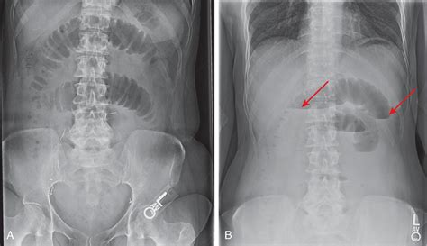 Small Bowel Obstruction Clinical Tree