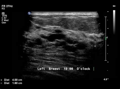Atlas Of Breast Cancer Early Detection