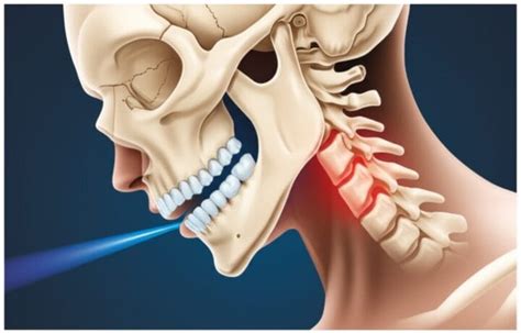 Temporomandibular Joint Dysfunction Self Care All About Tmj