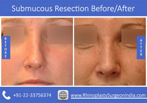 Submucous Resection Of Nasal Septum Procedure Rhinoplasty Surgeon India