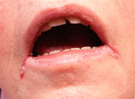 Virtual Grand Rounds In Dermatology 20 Zinc Deficiency Syndrome