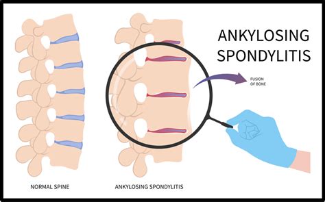 Bamboo Spine Ankylosing Spondylitis Spine Spine Education
