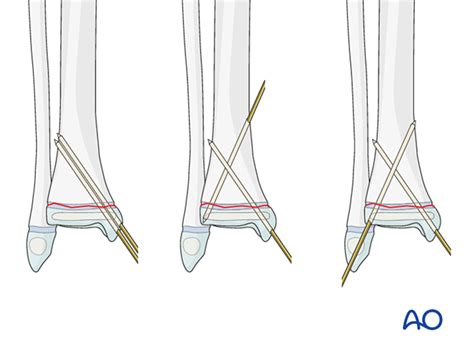 Open Reduction K Wire Fixation For Epiphysiolysis Salter Harris I Of The Distal Tibia