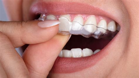 A Comprehensive Clear Aligners Faq South Florida Dentists
