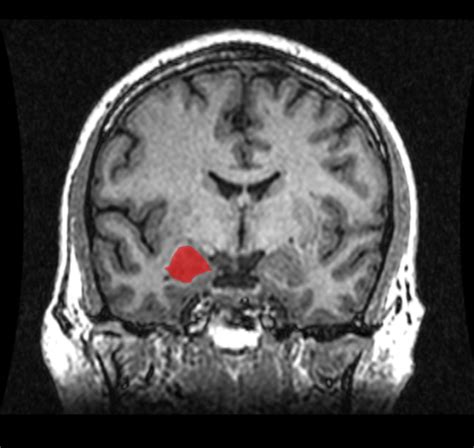 What Is The Difference Between Left And Right Amygdala Pediaacom