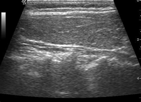 Gray Scale Sonography Of The Patients Thyroid Gland During Follow Up