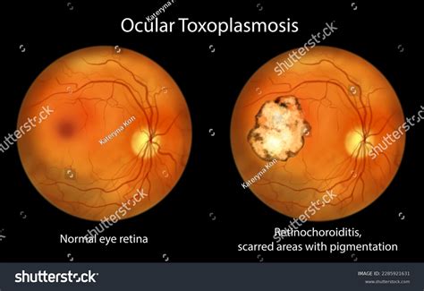 Retinal Scar Toxoplasmosis Disease Caused By Stock Illustration 2285921631 Shutterstock