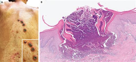 Images In Clinical Medicine Acquired Reactive Perforating Collagenosis