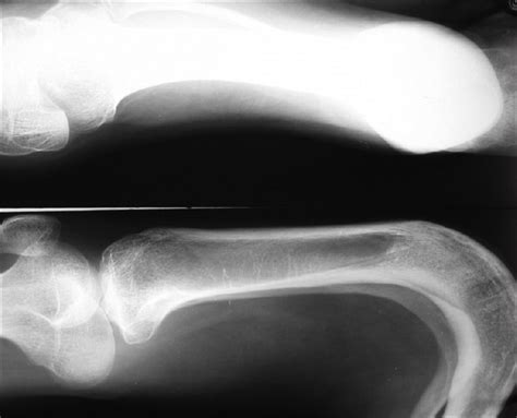 Posterioranterior And Lateral Leg Showed Bowing Of Tibia And Fibula