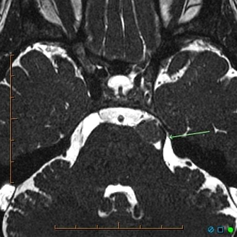 Ithy Unmasking Trigeminal Neuralgia Understanding The Suicide Disease