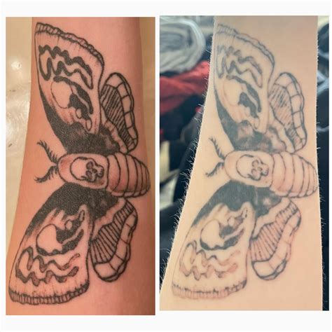 One Session Vs Fourth Session Rtattooremoval