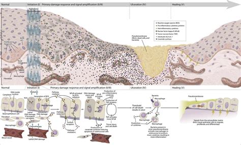 Chemotherapy Or Radiation Induced Oral Mucositis Pocket Dentistry