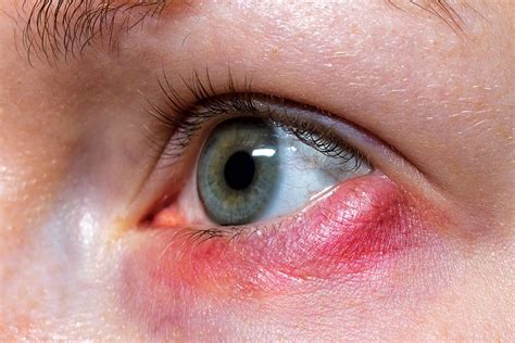 Stye Inside Eye Lid