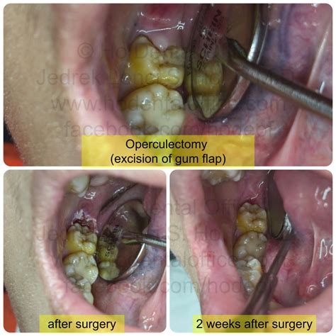 Operculectomy Dental Circumcision Ho Dental Office Dentist Binondo Manila Philippines