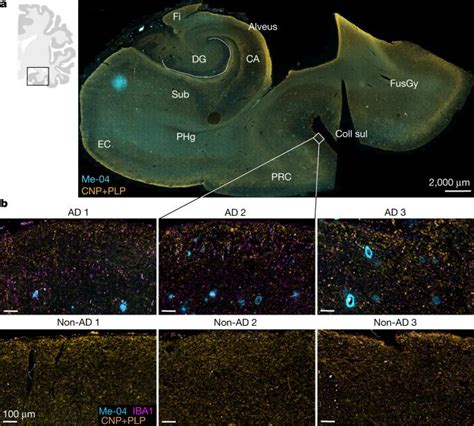 John Stockley On Linkedin Myelin Dysfunction Drives Amyloid β Deposition In Models Of Alzheimers
