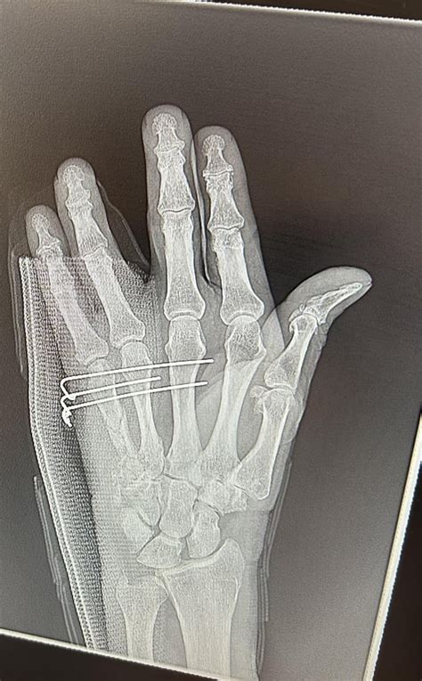 Broken Fifth Metacarpal And Base R Brokenbones