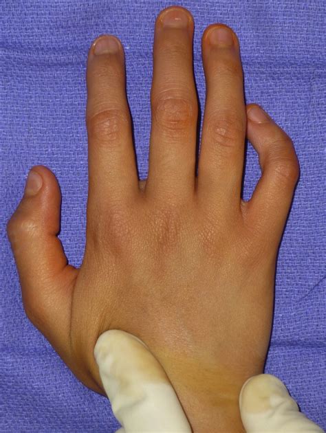 Osteotomy For Clinodactyly Journal Of Hand Surgery