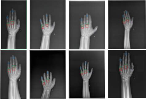 Samples Of Annotations Of The 3rd Metacarpal And 5th Metacarpal Red