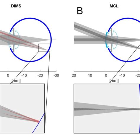Schematic Ray Tracing Through A Myopic Eye Demonstration Of Ray