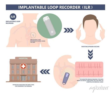 Loop Holter Event Atrial Heart Attack Stroke Ecg Ekg Device Monitoring Posters For The Wall