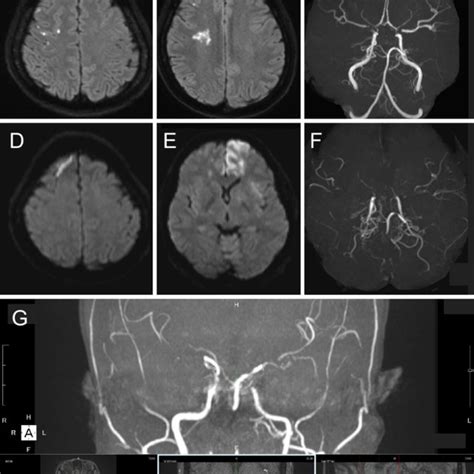 Figure2diffusion Weighted Brain Magnetic Resonance Imaging Mri A Download Scientific