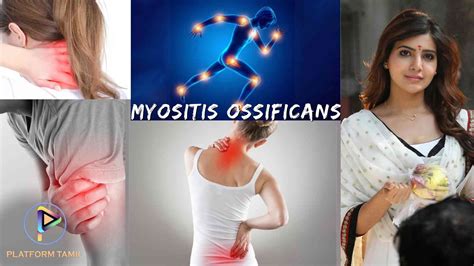 Myositis Symptoms And Types மயோசிடிஸ் எனும் அரிய நோய் பற்றிய விவரங்கள் Platform Tamil