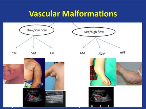 Vascular Anomalies Vascular Tumours And Vascular Malformations Pptx