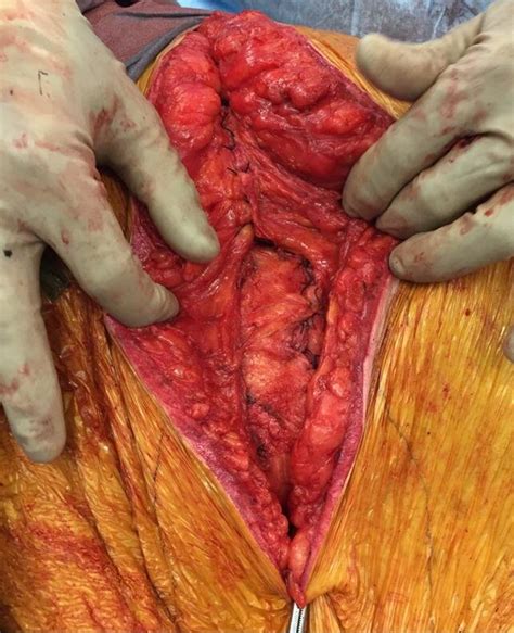 Reduction Of Hernia Content And Primary Closure Of The Defect Download Scientific Diagram