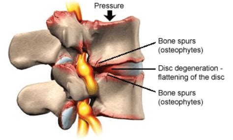 Degenerative Scoliosis Specialist In Delray Beach Fl And Fort Lauderdale