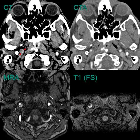 Arterial Dissection Neuroradiology