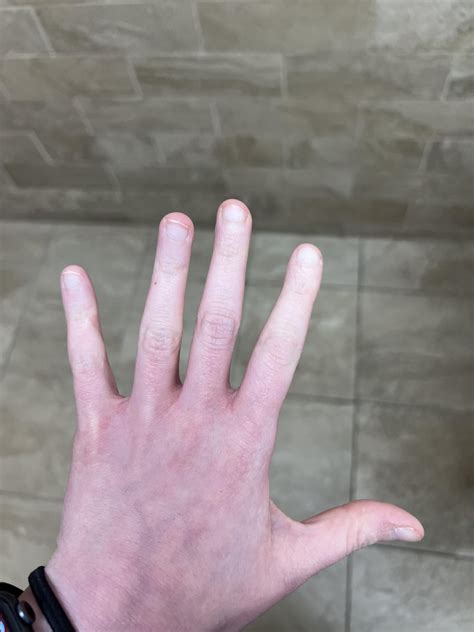 Is This Raynauds R Raynauds