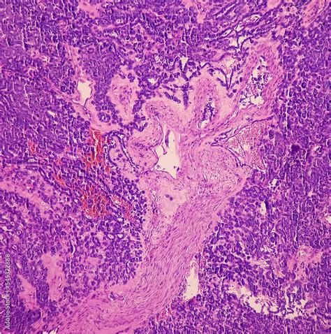 Thyroid Cancer Microscopic Image Of Follicular Variant Of Papillary Carcinoma Malignant