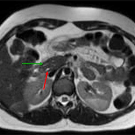 Axial Section Of Mrcp In T2 Single Shot Fast Spin Echo Sequence