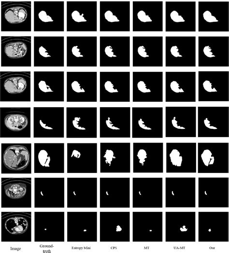 Figure 8 From An Effective Semi Supervised Approach For Liver Ct Image Segmentation Semantic