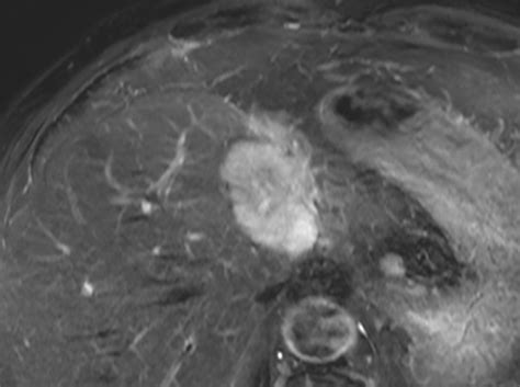 Intrahepatic Mass Forming Cholangiocarcinoma Arterial Enhancement