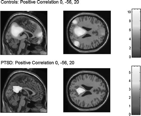 1 Default Mode Network Connectivity In Control Top Panel And Ptsd