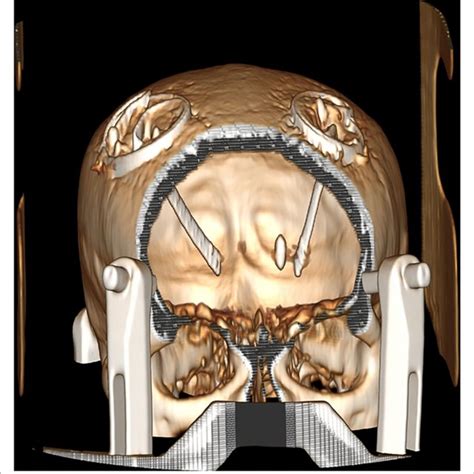Three Dimensional Reconstruction After The Dbs Implantation