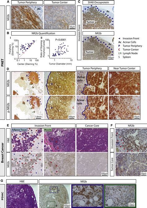 Hijacking The Neuronal Nmdar Signaling Circuit To Promote Tumor Growth And Invasion Cell