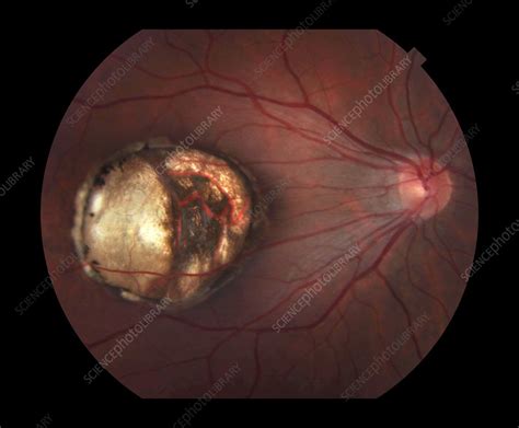 Retinal Coloboma Stock Image C0306929 Science Photo Library