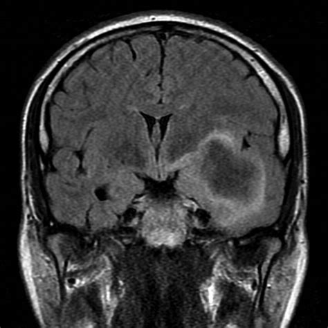 Radiopaedia Case Diffuse Astrocytoma NOS Id 10183 Study 10718 NC Commons