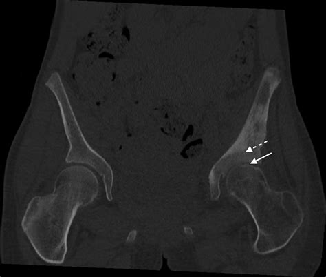 Imaging Findings In A Case Of Severe Chronic Osteomyelitis Archives