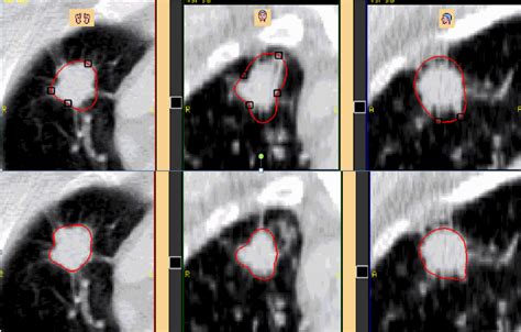 Lung Tumor Segmentation In Base Line Scan First Row Example Of An