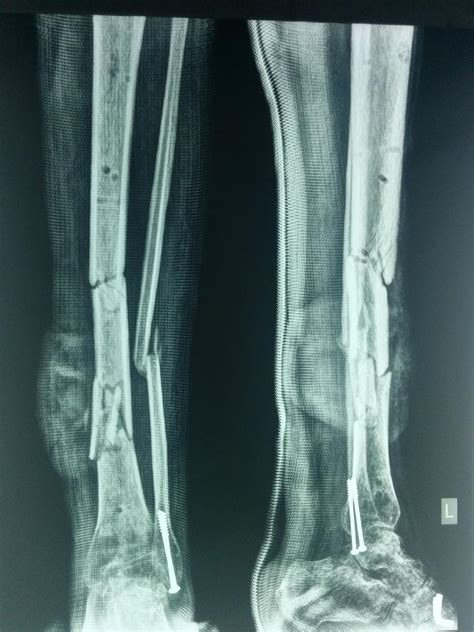 Tibia Shaft Fractures Trauma Orthobullets Com