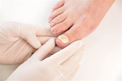 What Are Fungal Nails My FootDr
